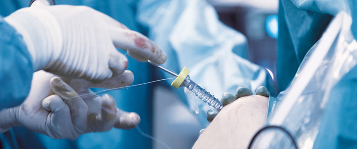 Arthroscopie d'épaule - Fondation Hopale